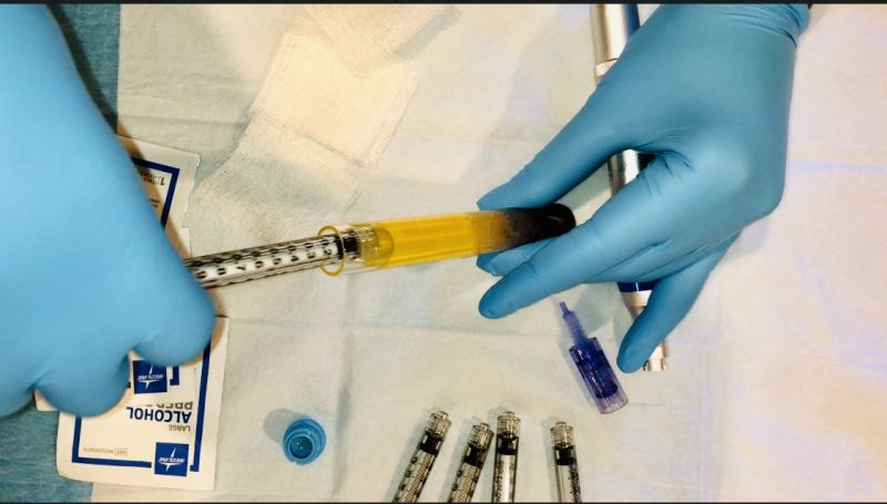 Microneedling with PRP Preparation: Step by Step | Juventix